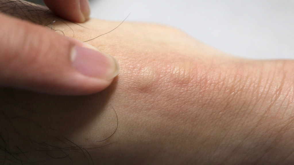 Identifying Insect Bites: Pictures, Causes & How to Get Rid of Them ...